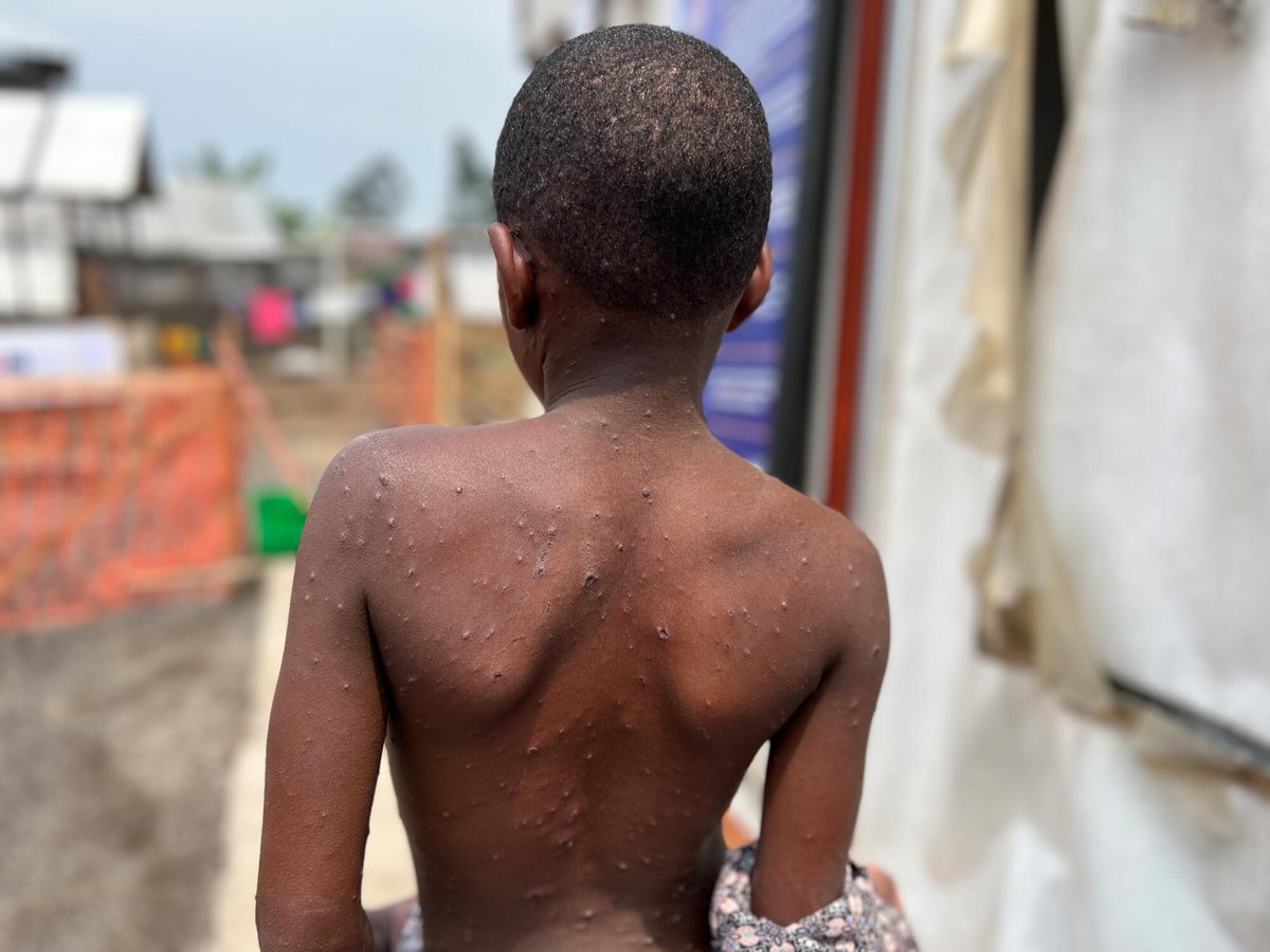 EU and Africa to ramp up Mpox testing